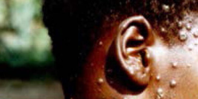 Monkeypox: How to Get It, Symptoms, Treatments and Vaccines